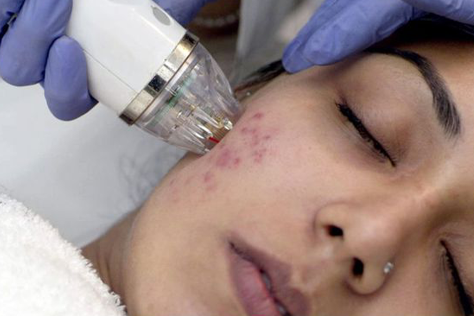 Micro-Needling / Vampire Facial - CFH Hair Transplant